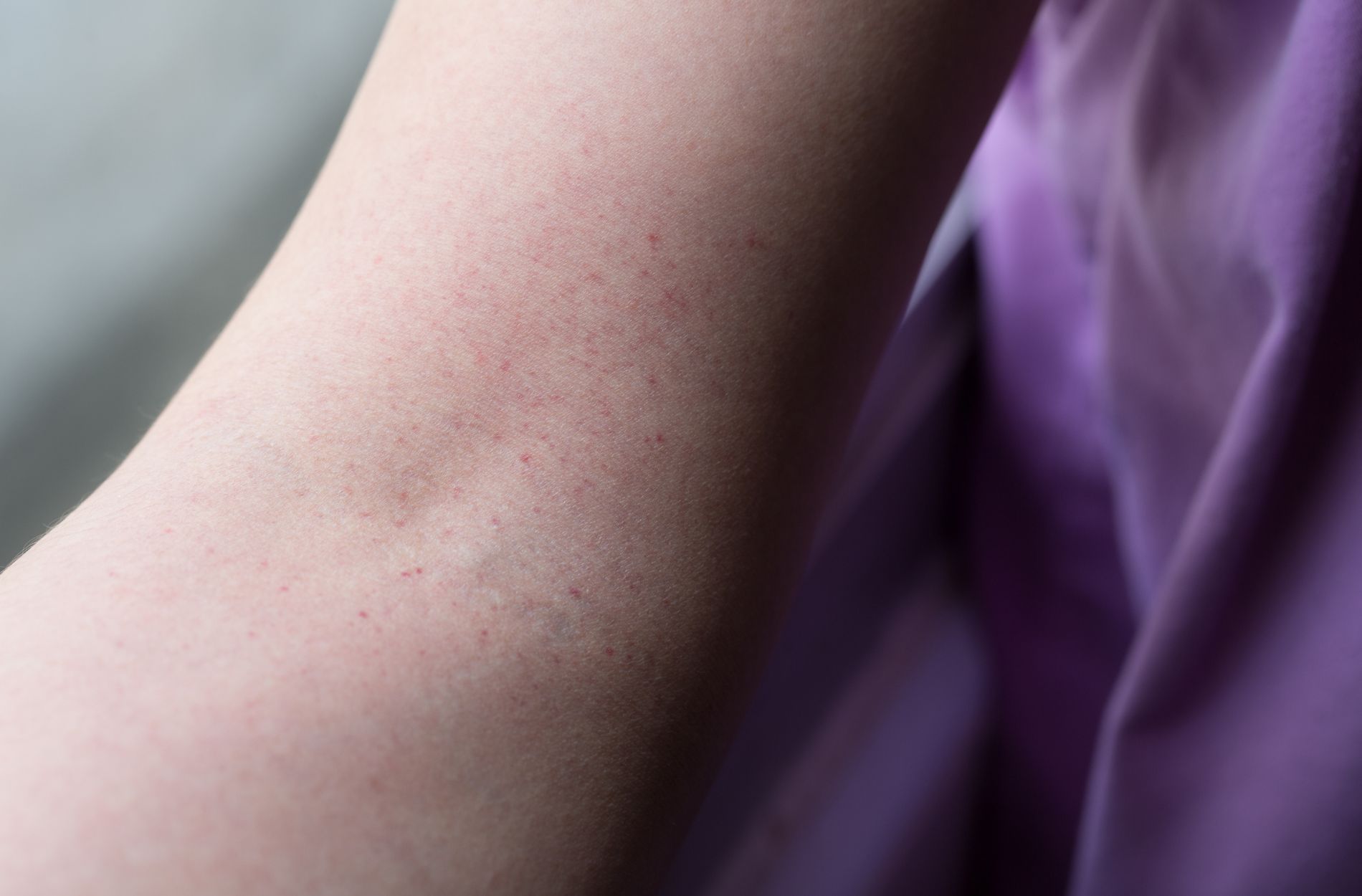 Steps to Take After a Stevens-Johnson Diagnosis